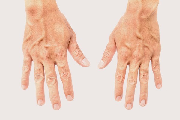 Käte ja käsivarte varikoosi ravi - Estmedica