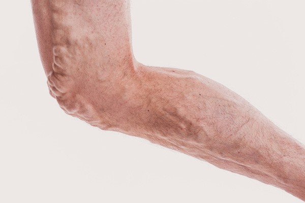 Miniflebektoomia - Estmedica